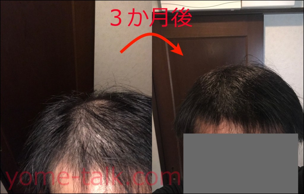 3ヶ月で頭頂部ハゲを改善させたコスパ最強の育毛方法(画像付)！ | 嫁に聞いた話